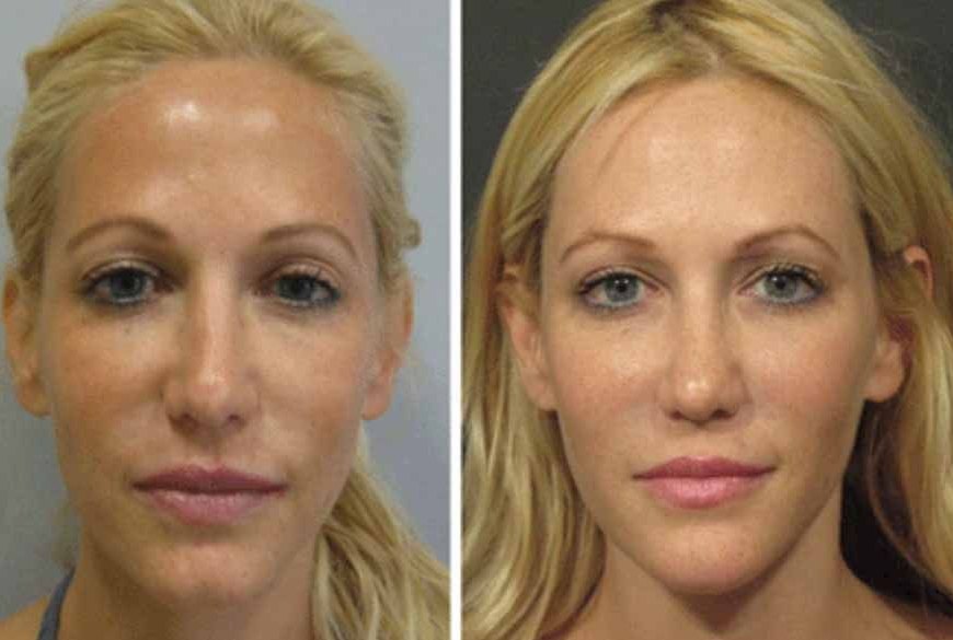 فيلر الخدود: التكلفة، الأنواع، التحضيرات، المخاطر، سلبيات وإيجابيات ...